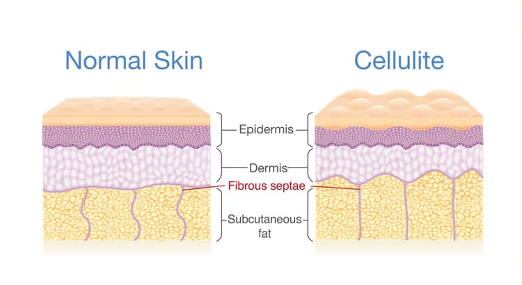 Top Tips For Getting Rid Of Cellulite